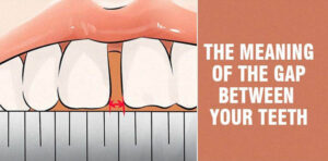 Do You Have A Gap Between Your Teeth? This Is What It Means! - Overdose ...